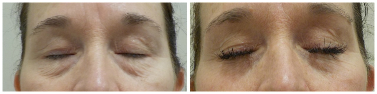 What is LipoMelt, and is it for you? – IMPACT Health 360